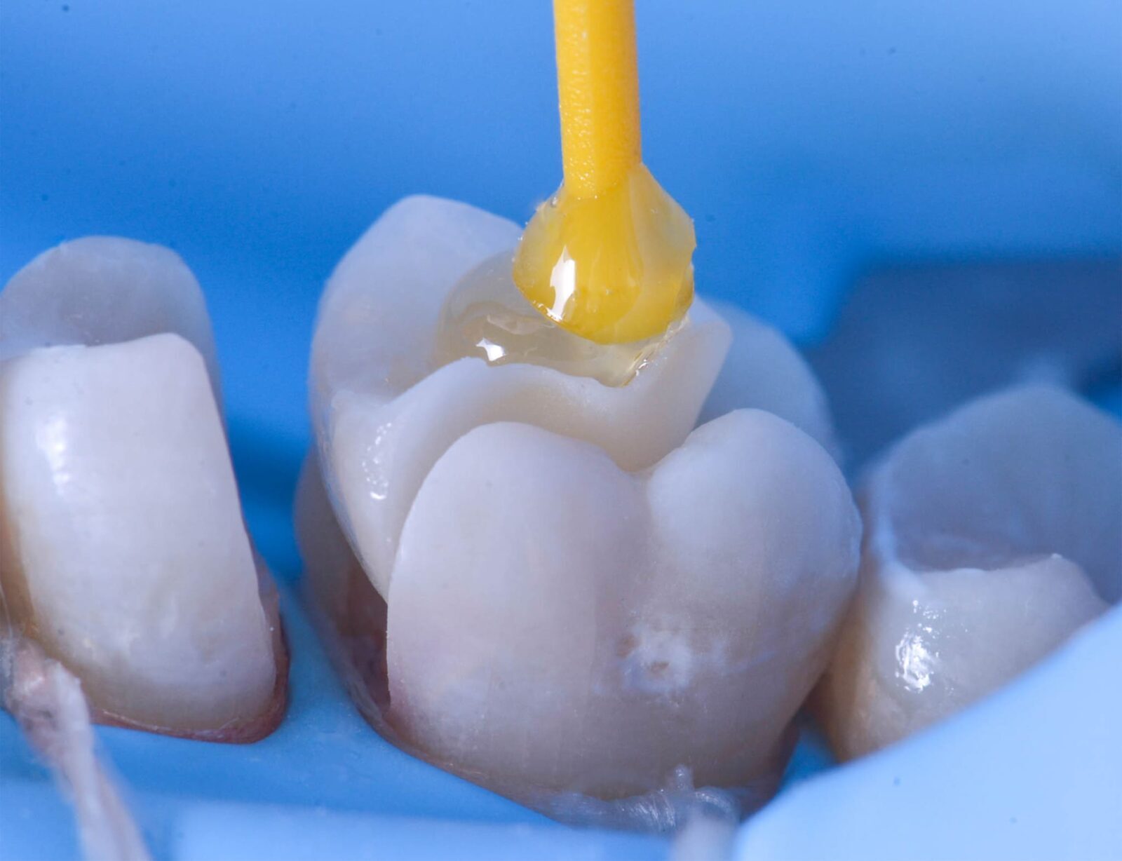 Inlay, Onlay, Overlay : de la préparation au collage | GAD Center ...